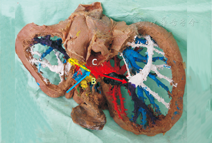 左半肝Glisson系统的应用解剖学研究 - 中华解剖与临床杂志