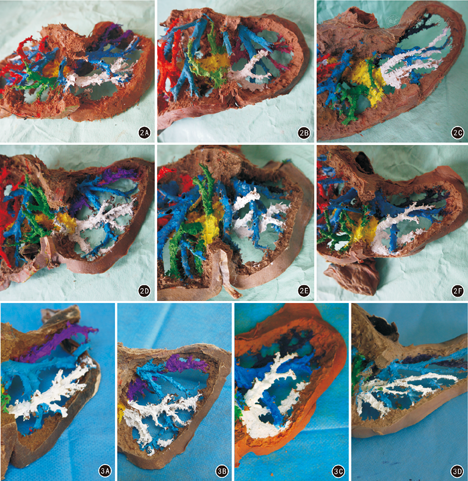 左半肝Glisson系统的应用解剖学研究 - 中华解剖与临床杂志