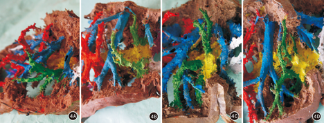 左半肝Glisson系统的应用解剖学研究 - 中华解剖与临床杂志