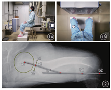 单次曝光改良Budin位X线片测量髋关节发育不良患者股骨前倾角的临床应用 - 中华解剖与临床杂志