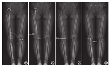 运动学对线全膝关节置换股骨滑车截骨面解剖适配与下肢对线参数的相关性研究 - 中华解剖与临床杂志