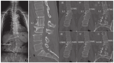 基于椎体CT扫描的骨密度HU值分析退变性腰椎侧弯患者骨质疏松的发生率和分布规律 - 中华解剖与临床杂志
