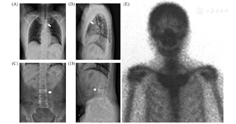 SAPHO综合征并严重骨质疏松症一例 - 中华内分泌代谢杂志