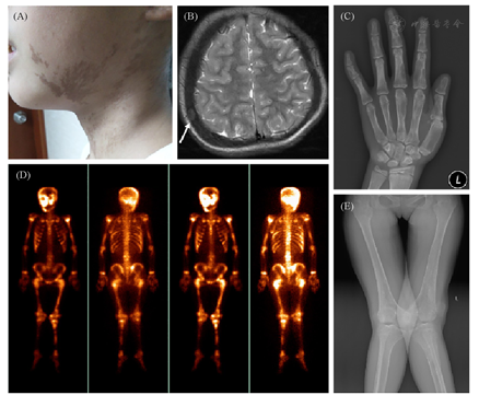 一例伴低磷性佝偻病的McCune-Albright综合征临床分析及GNAS基因检测 - 中华内分泌代谢杂志