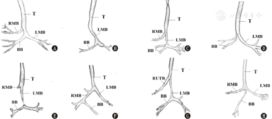 儿童先天性支气管桥畸形临床与解剖形态分析 - 中华实用儿科临床杂志