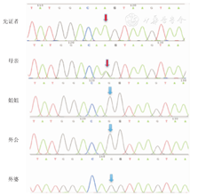 HPRT1基因突变致Lesch-Nyhan综合征1例临床特点及基因分析 - 中华实用儿科临床杂志