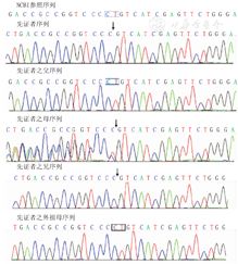 SLC6A8基因新发突变致肌酸缺乏综合征一家系 - 中华实用儿科临床杂志