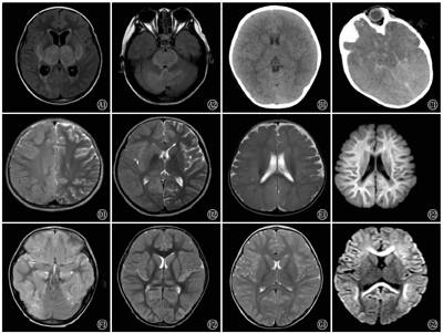 儿童流感相关脑病40例临床影像学特征及预后分析 - 中华实用儿科临床杂志