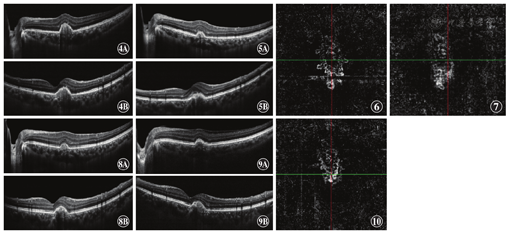 应用OCT血管成像技术随访雷珠单抗治疗特发性脉络膜新生血管一例 - 中华实验眼科杂志