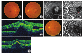 复发性息肉状脉络膜血管病变一例 - 中华实验眼科杂志