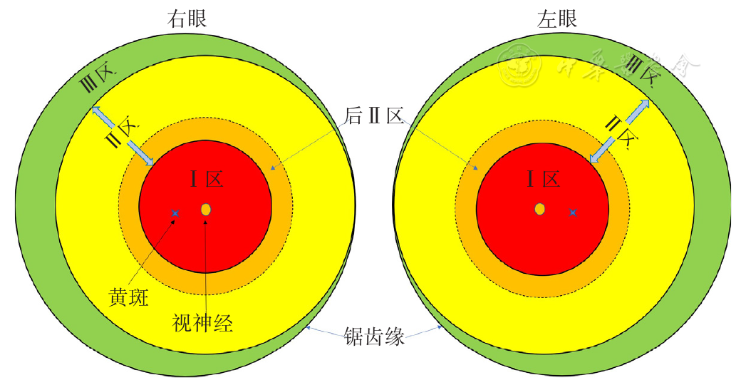日本眼科学会《早产儿视网膜病变的抗VEGF疗法临床指南》解读 - 中华实验眼科杂志