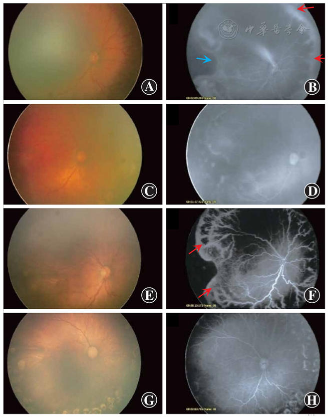 日本眼科学会《早产儿视网膜病变的抗VEGF疗法临床指南》解读 - 中华实验眼科杂志