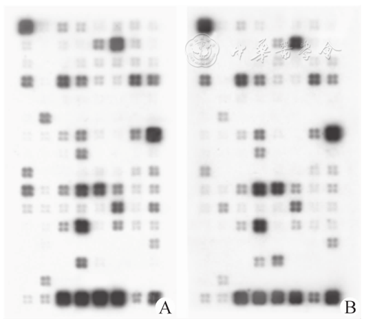 RECK及MMP-2、MMP-9在神经母细胞瘤组织中的表达与肿瘤侵袭转移研究