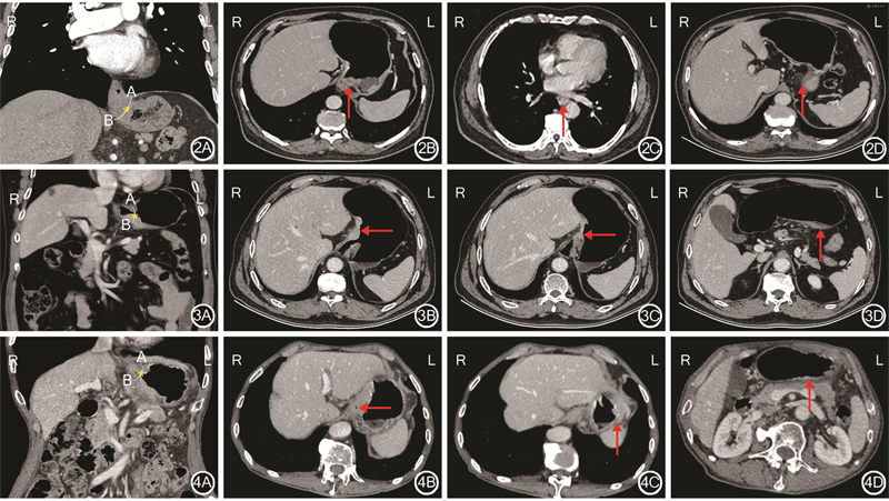 CT检查三段公式法判断食管胃结合部腺癌Siewert分型的临床价值 - 中华消化外科杂志