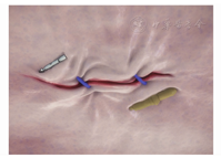 OverStitch缝合技术在治疗消化道缺损等疾病及内镜减重中的新进展 - 中华消化杂志