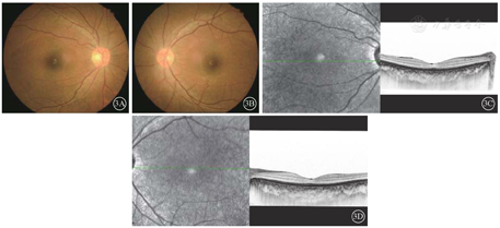 急性B淋巴细胞白血病致类Vogt-小柳原田综合征一例 - 中华眼底病杂志