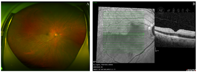 急性黄斑旁中心中层视网膜病变进展为BRAO一例 - 中华眼视光学与视觉科学杂志