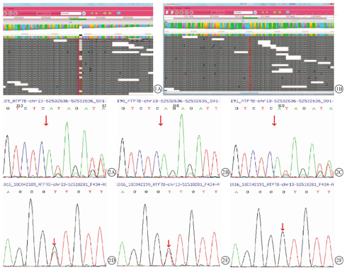 ATP7B基因变异致脑型肝豆状核变性一例 - 中华医学遗传学杂志