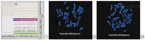 一例22q11.21微缺失胎儿的产前诊断 - 中华医学遗传学杂志