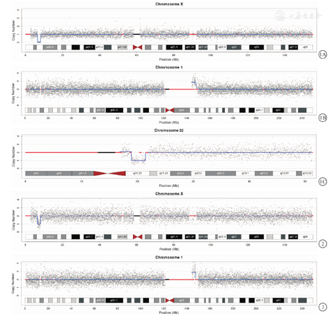 低深度全基因组测序发现胎儿同时携带Xp22.31缺失、1q21.1微重复和22q11微缺失一例 - 中华医学遗传学杂志