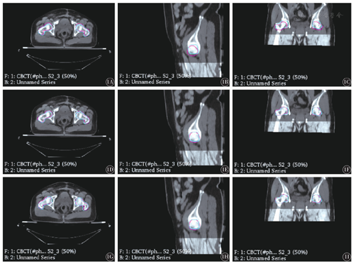 基于3D Slicer软件的CT图像配准在子宫颈癌放疗中的应用研究 - 肿瘤研究与临床
