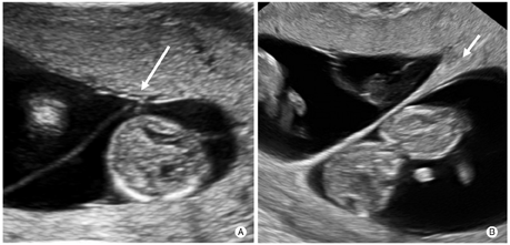 Complications of Monochorionic Diamniotic Twins: Stepwise Approach for ...