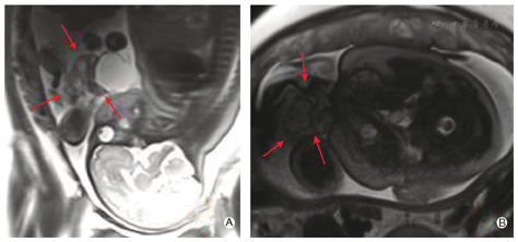 Prenatal Diagnosis of a Giant Epignathus in the Second Trimester and ...