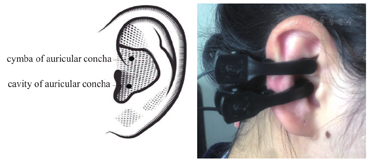 Efficacy and brain mechanism of transcutaneous auricular vagus nerve ...