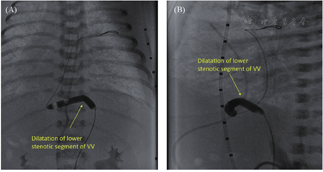 Obstructed infracardiac total anomalous pulmonary venous connection ...