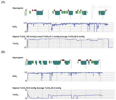 Non-invasive home ventilation using the average volume assured pressure ...