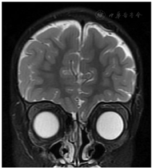 Bath-plug technique for the endoscopic management of cerebrospinal ...