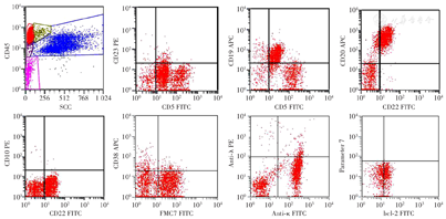 惰性白血病期套细胞淋巴瘤1例临床和实验室诊断分析并文献复习 - 白血病·淋巴瘤