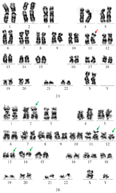NUP98-DDX10融合基因阳性急性白血病2例并文献复习 - 白血病·淋巴瘤
