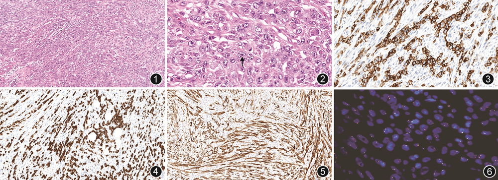 肉瘤样型间变性淋巴瘤激酶阳性间变性大细胞淋巴瘤1例