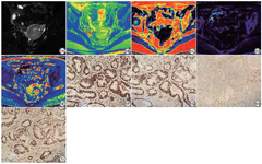 T2 mapping联合mDixon-Quant多参数成像定量评估子宫内膜癌微卫星不稳定状态的研究 - 磁共振成像