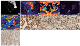 T2 mapping联合mDixon-Quant多参数成像定量评估子宫内膜癌微卫星不稳定状态的研究 - 磁共振成像