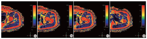 基于磁共振mDIXON-Quant技术对健康受试者股骨近端骨髓脂肪定量研究 - 磁共振成像