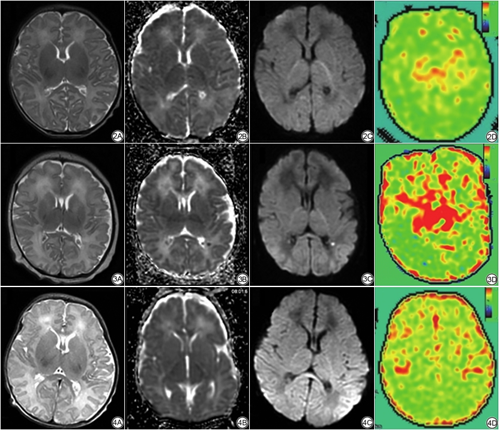 三维动脉自旋标记在足月新生儿缺氧缺血性脑病的早期诊断和预后分组中的价值 - 磁共振成像