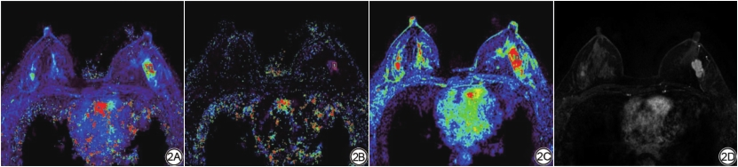 DCE-MRI影像特征对乳腺癌激素受体、HER-2及三阴性乳腺癌的预测价值 - 磁共振成像