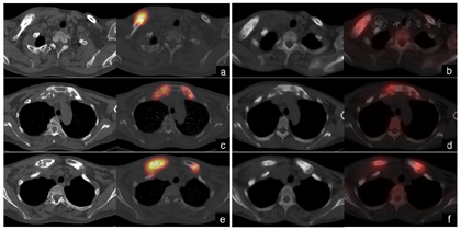 99mTc-MDP/99Tc-MDP靶向诊疗SAPHO综合征1例 - 中国临床案例成果数据库