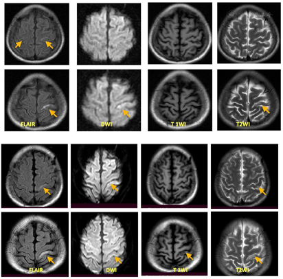mt-ND3突变所致Rolandic区反复病变的线粒体脑病1例 - 中国临床案例成果数据库