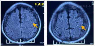 mt-ND3突变所致Rolandic区反复病变的线粒体脑病1例 - 中国临床案例成果数据库