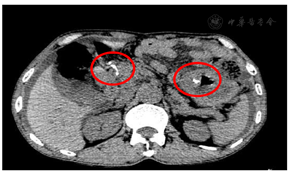 Roux-en-Y吻合术后Petersen疝1例 - 中国临床案例成果数据库