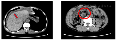 Roux-en-Y吻合术后Petersen疝1例 - 中国临床案例成果数据库