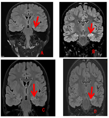 CUX2基因变异致发育性癫痫脑病67型1例 - 中国临床案例成果数据库