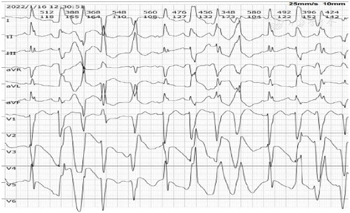 ECMO辅助治疗反复室颤的先天性长QT综合征1例 - 中国临床案例成果数据库