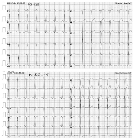 TEER联合CHIP-PCI治疗缺血性心肌病心力衰竭1例 - 中国临床案例成果数据库