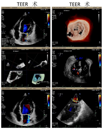 TEER联合CHIP-PCI治疗缺血性心肌病心力衰竭1例 - 中国临床案例成果数据库