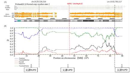 GPT2基因变异和单亲二倍体所致精神发育迟滞49型1例 - 中国临床案例成果数据库