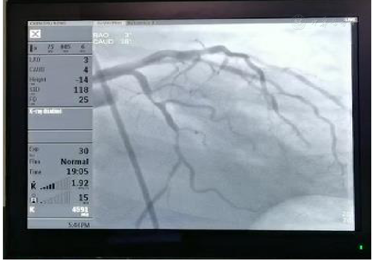 ECMO辅助下急诊PCI治疗急性心梗1例 - 中国临床案例成果数据库